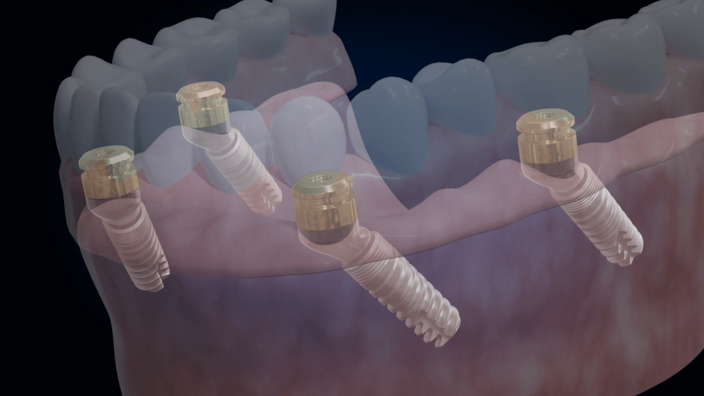 Tele-Magnetic Abutments – ABraCadabra