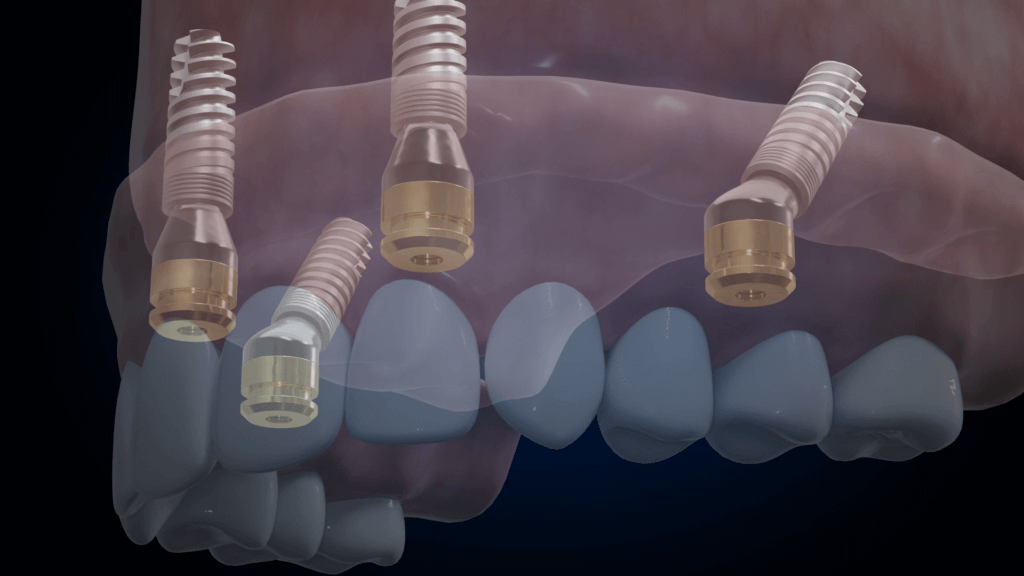 Tele-Magnetic Abutments – ABraCadabra